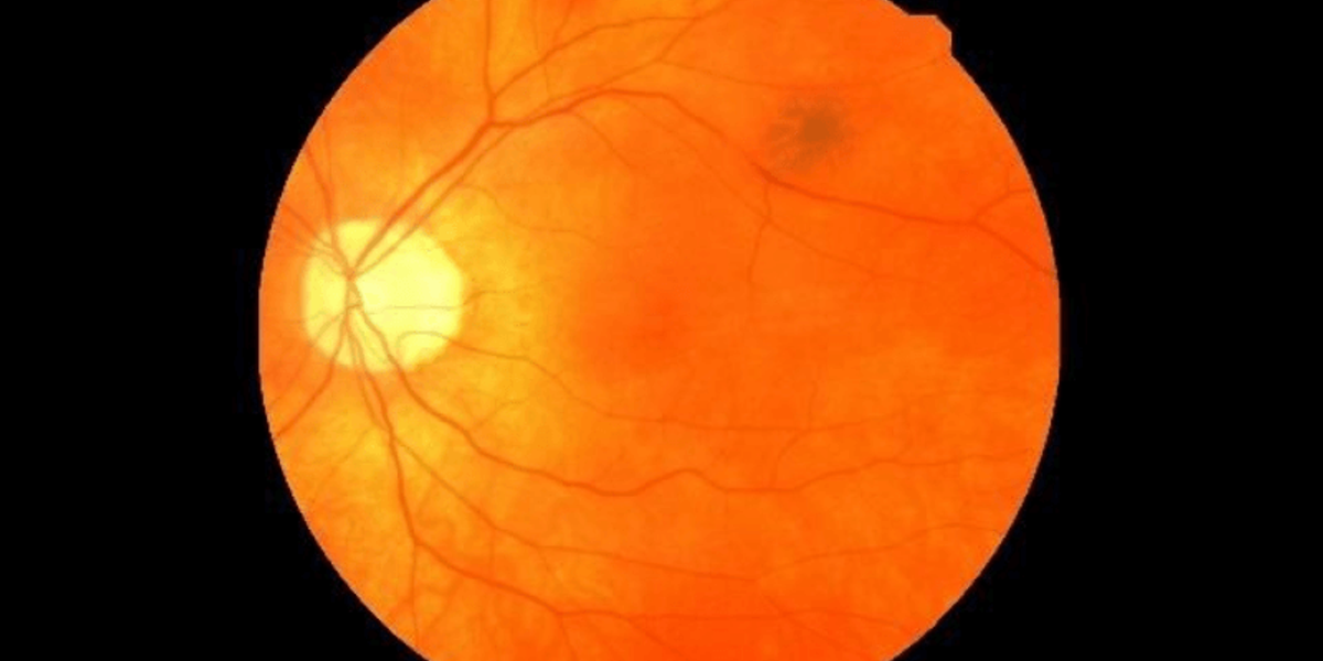 Can Retinal Scans Help in Predicting Myocardial Infarction?
